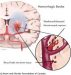 Penyakit Stroke: Mengenal, Mencegah, Dan Mengobati » 2026