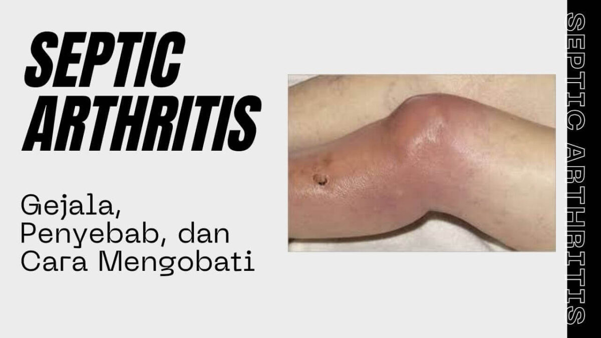 Septic Arthritis: Gejala, Penyebab, Dan Cara Mengatasinya Dengan Cepat ...