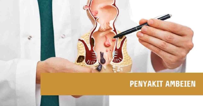 Penyakit Ambeien: Penyebab, Gejala, Dan Cara Pengobatan » 2026
